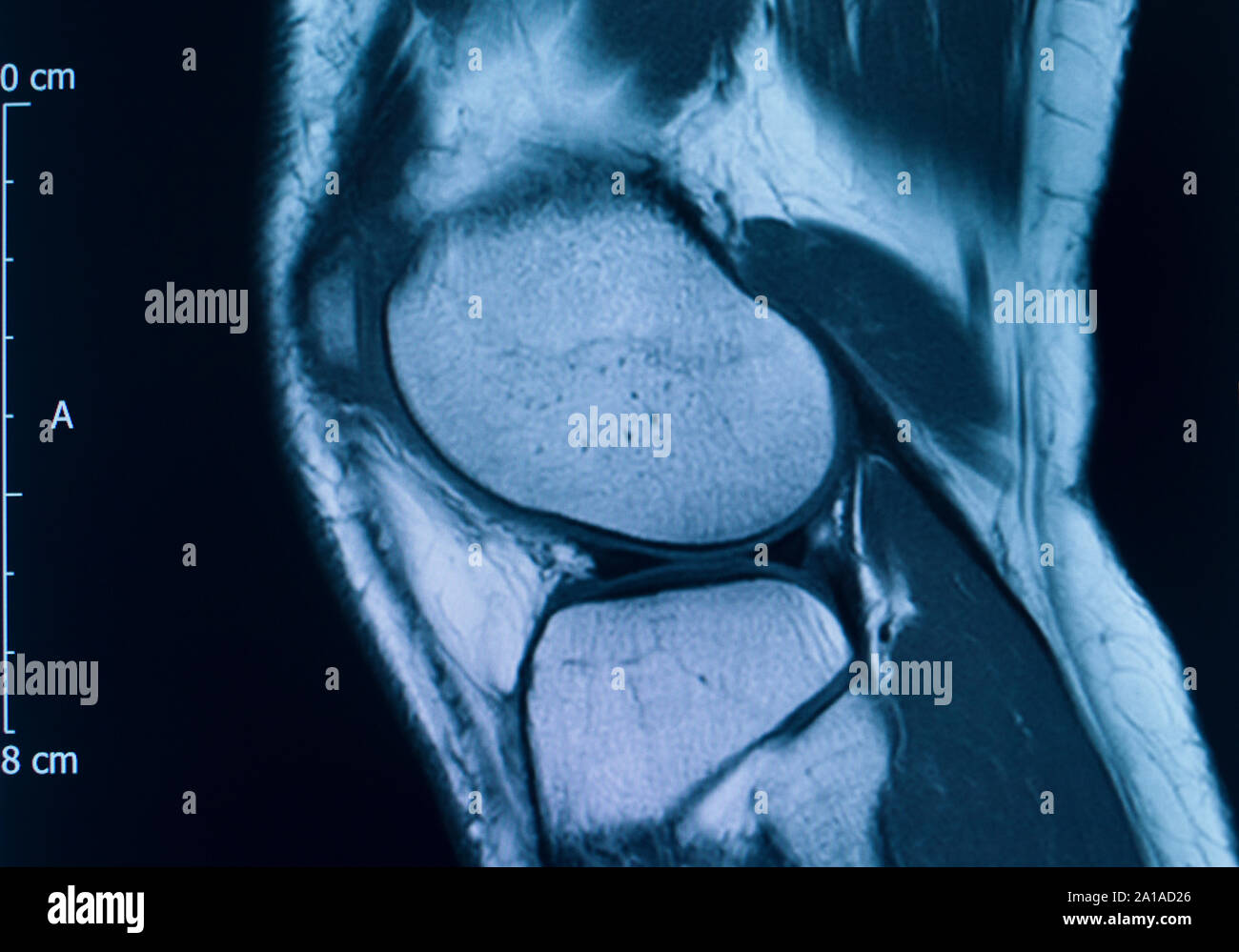 Knee sports injury mri mcl grade 2 tear magnetic resonance imaging ...