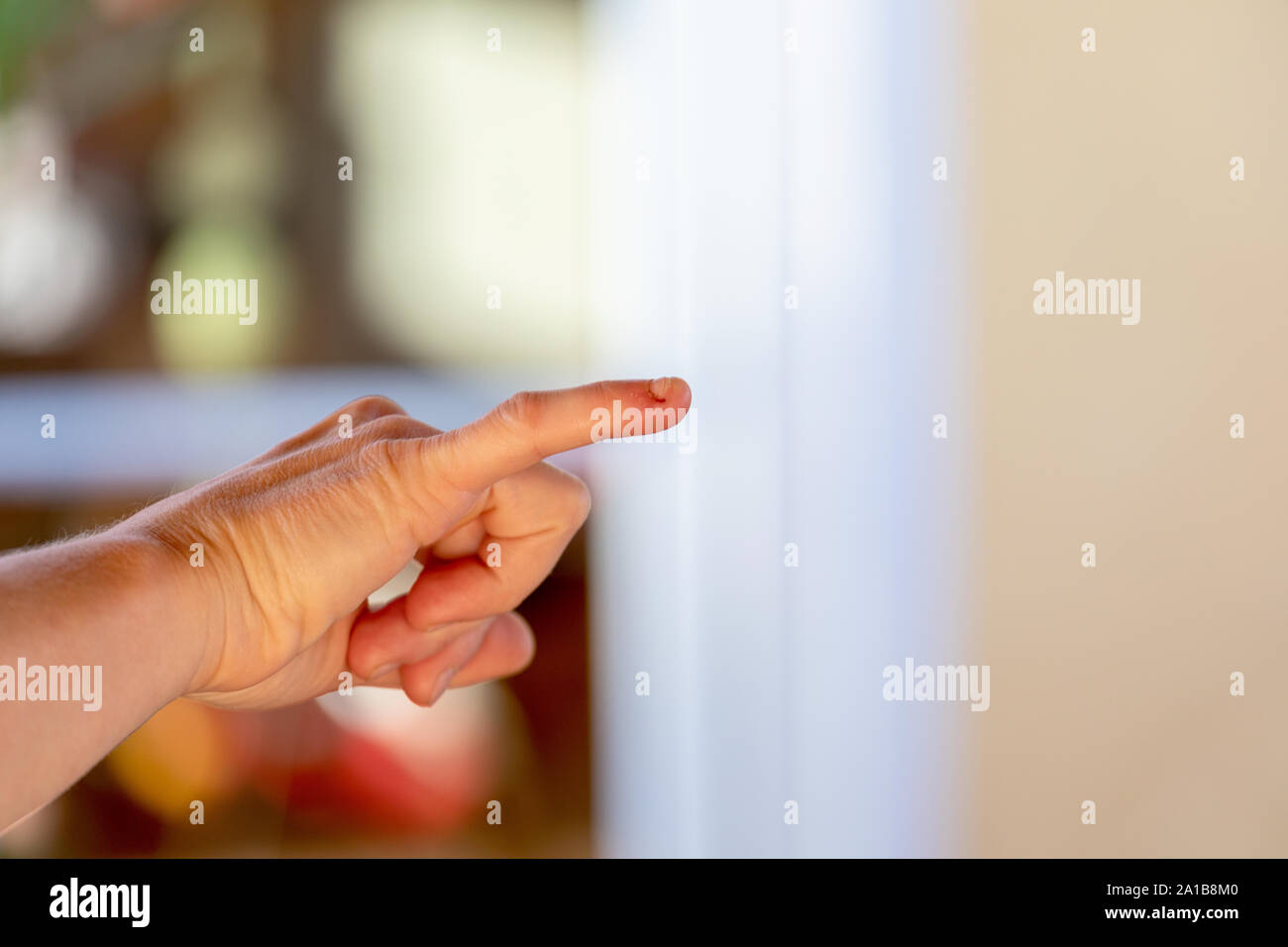 Hand lesion hi-res stock photography and images - Alamy