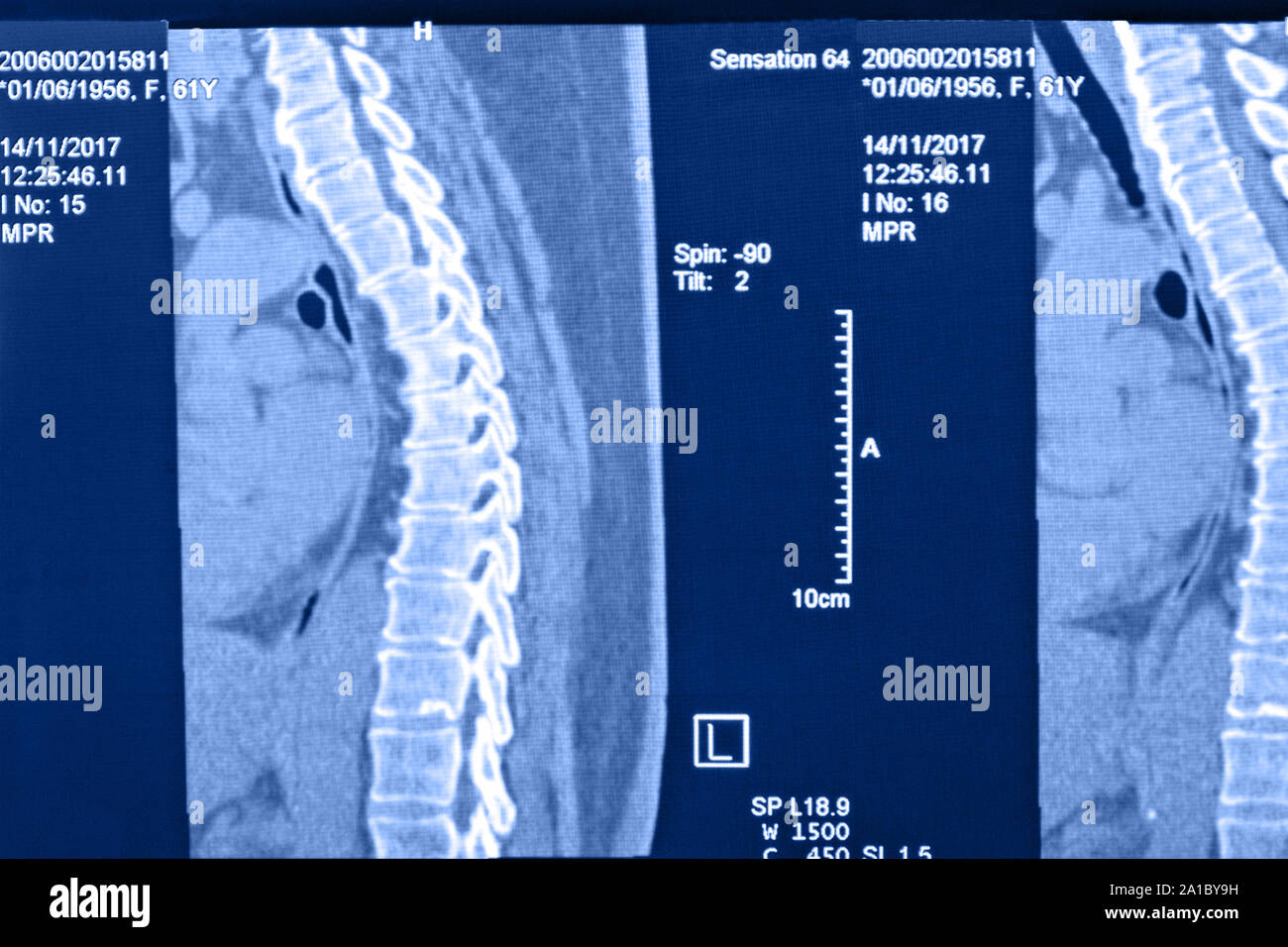 Mri of back pain hi-res stock photography and images - Alamy