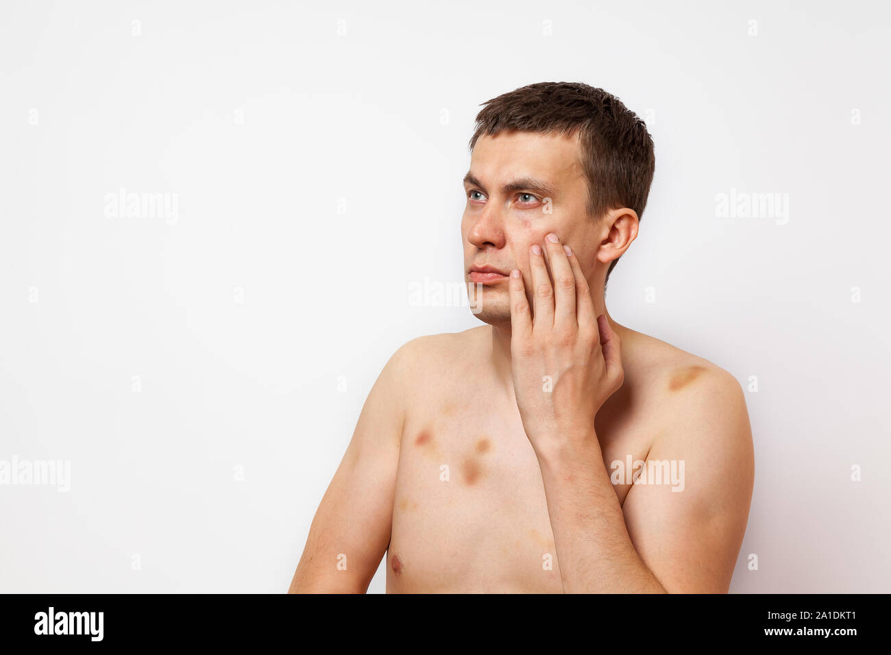 Brunette man with bruises on his body holds his hand to his head in ...