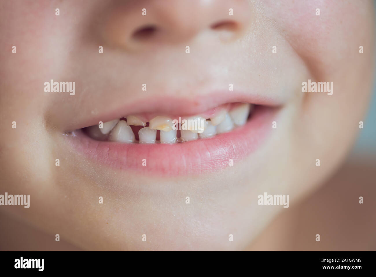 Rotten teeth baby hi-res stock photography and images - Alamy