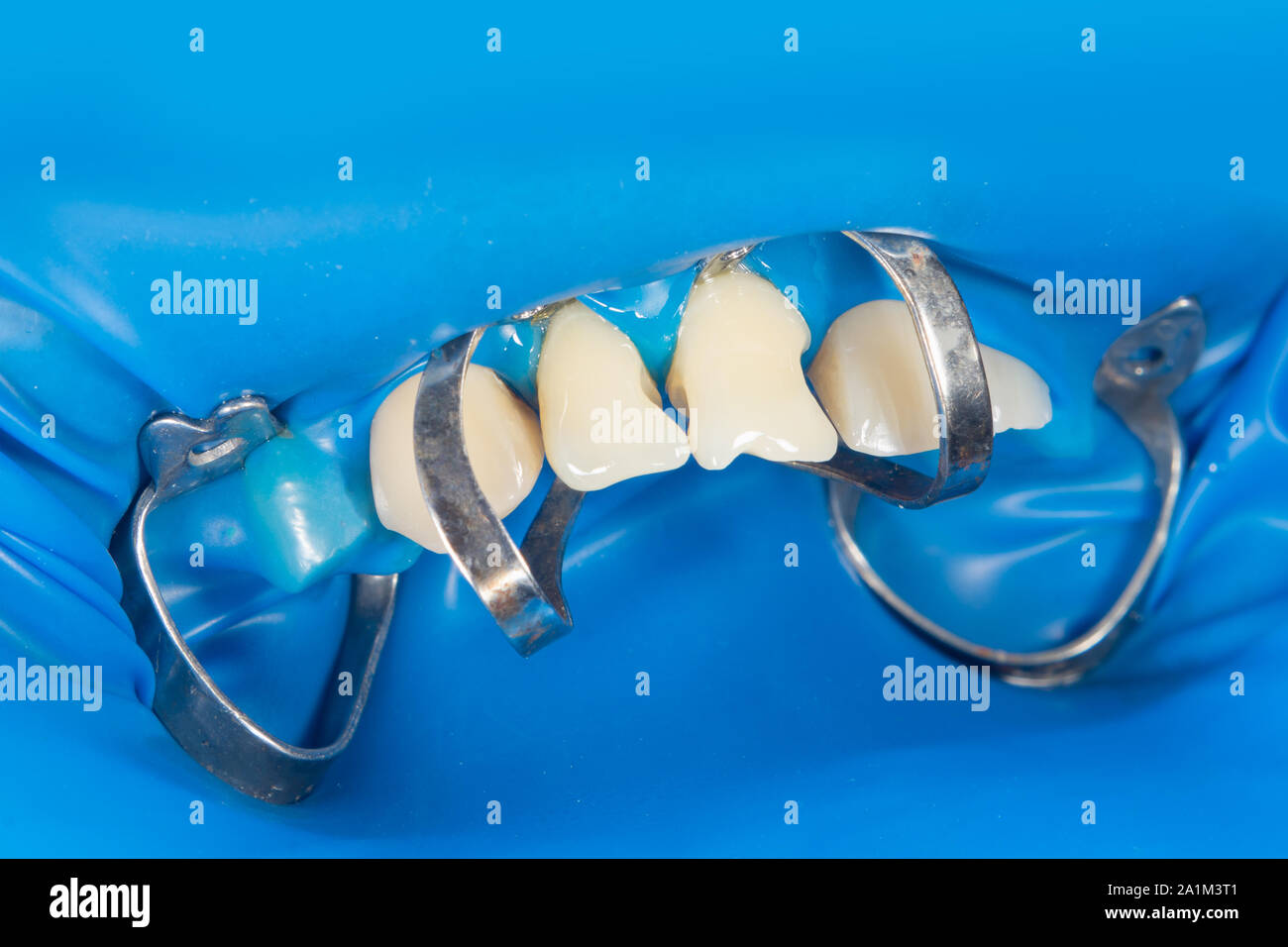 filling of human teeth, close-up. Treatment with polymer fillings at ...