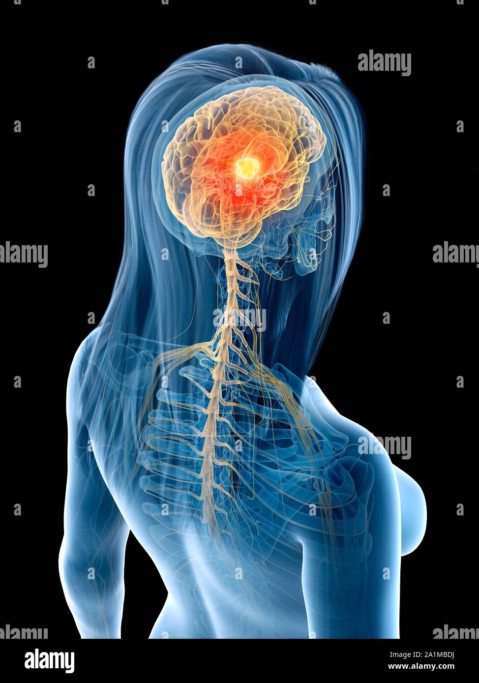 Brain cancer, conceptual computer illustration Stock Photo - Alamy