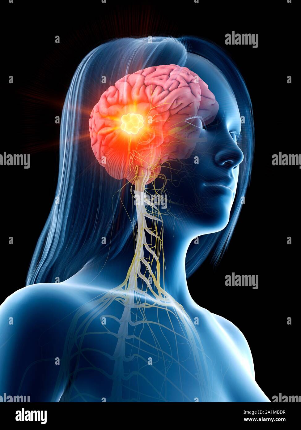Brain cancer, conceptual computer illustration Stock Photo - Alamy