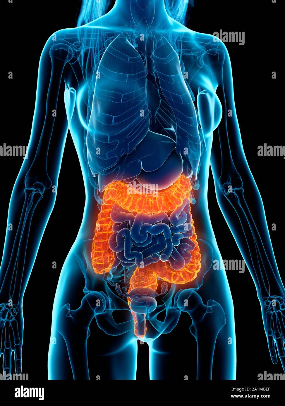 Diseased colon, computer illustration Stock Photo - Alamy