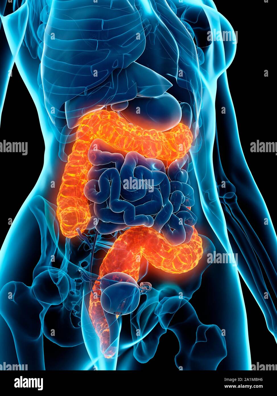 Diseased colon, computer illustration Stock Photo - Alamy