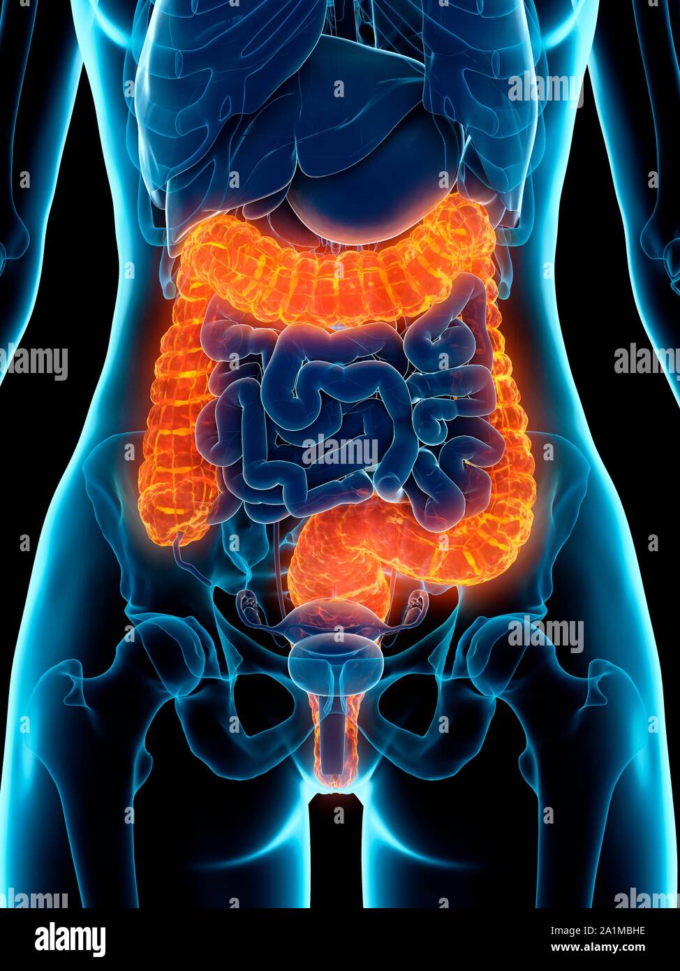 Diseased colon, computer illustration Stock Photo - Alamy