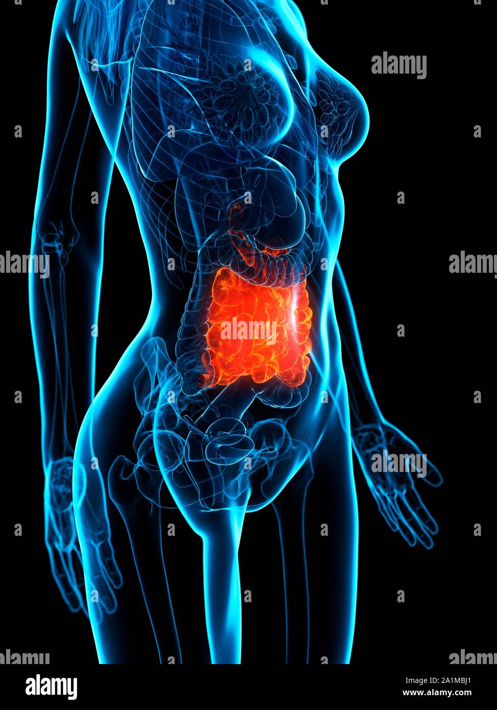 Diseased small intestine, computer illustration Stock Photo - Alamy