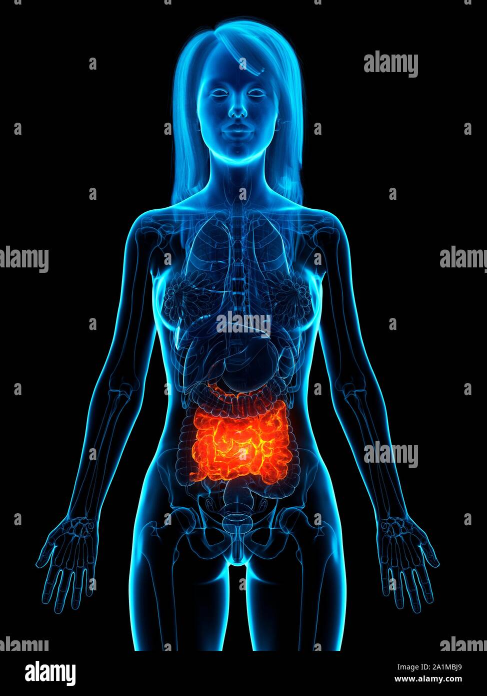 Diseased small intestine, computer illustration Stock Photo - Alamy