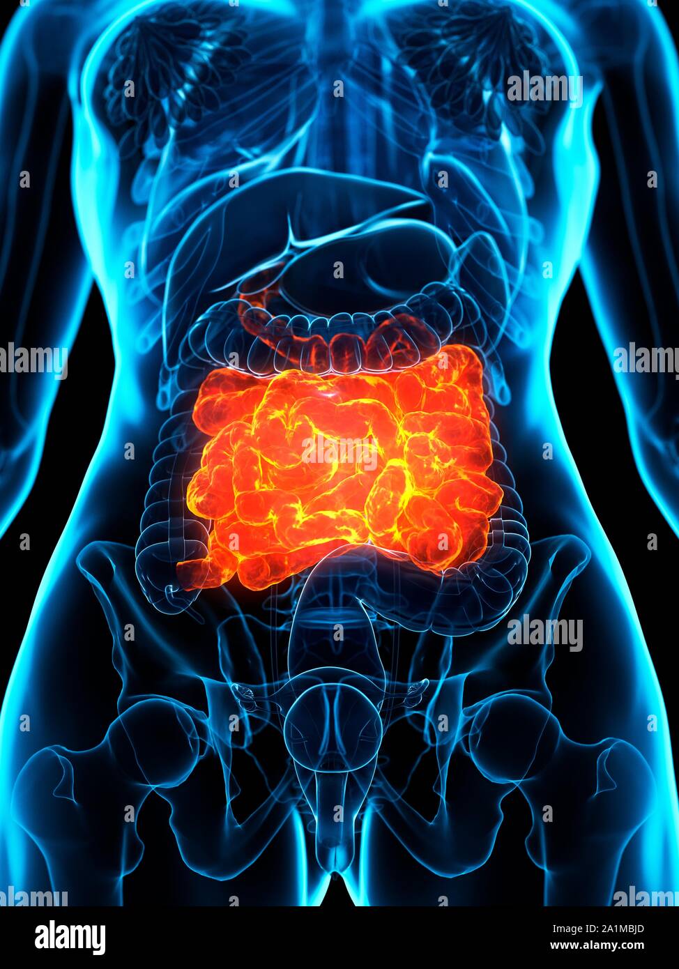 Diseased small intestine, computer illustration Stock Photo - Alamy