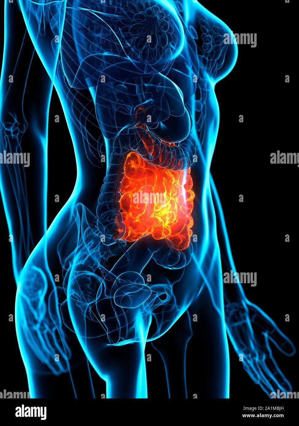 Diseased small intestine, computer illustration Stock Photo - Alamy