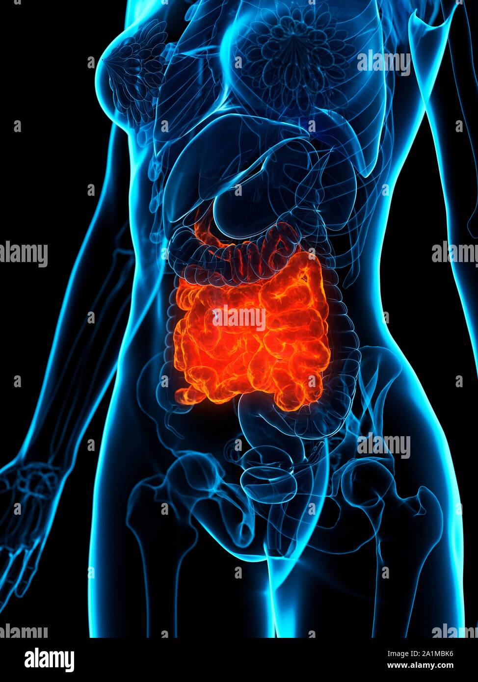Diseased small intestine, computer illustration Stock Photo - Alamy