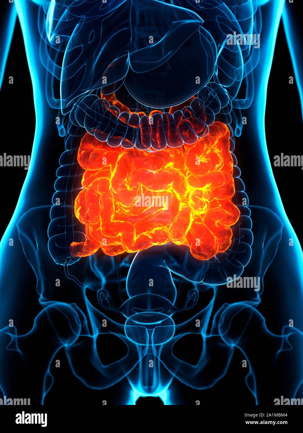 Diseased small intestine, computer illustration Stock Photo - Alamy