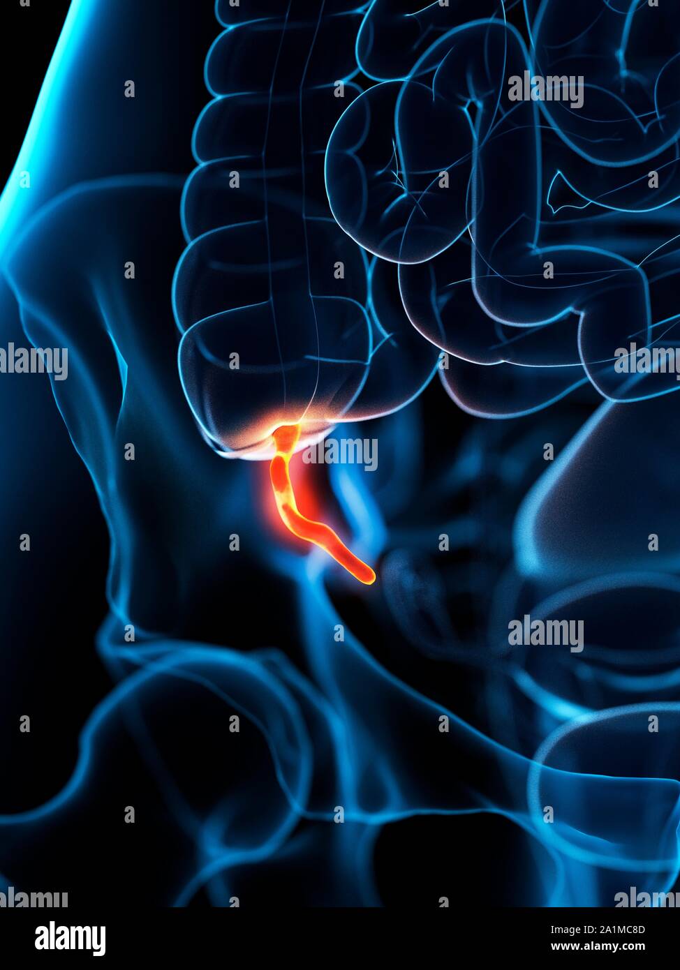 Inflamed appendix, conceptual computer illustration Stock Photo - Alamy