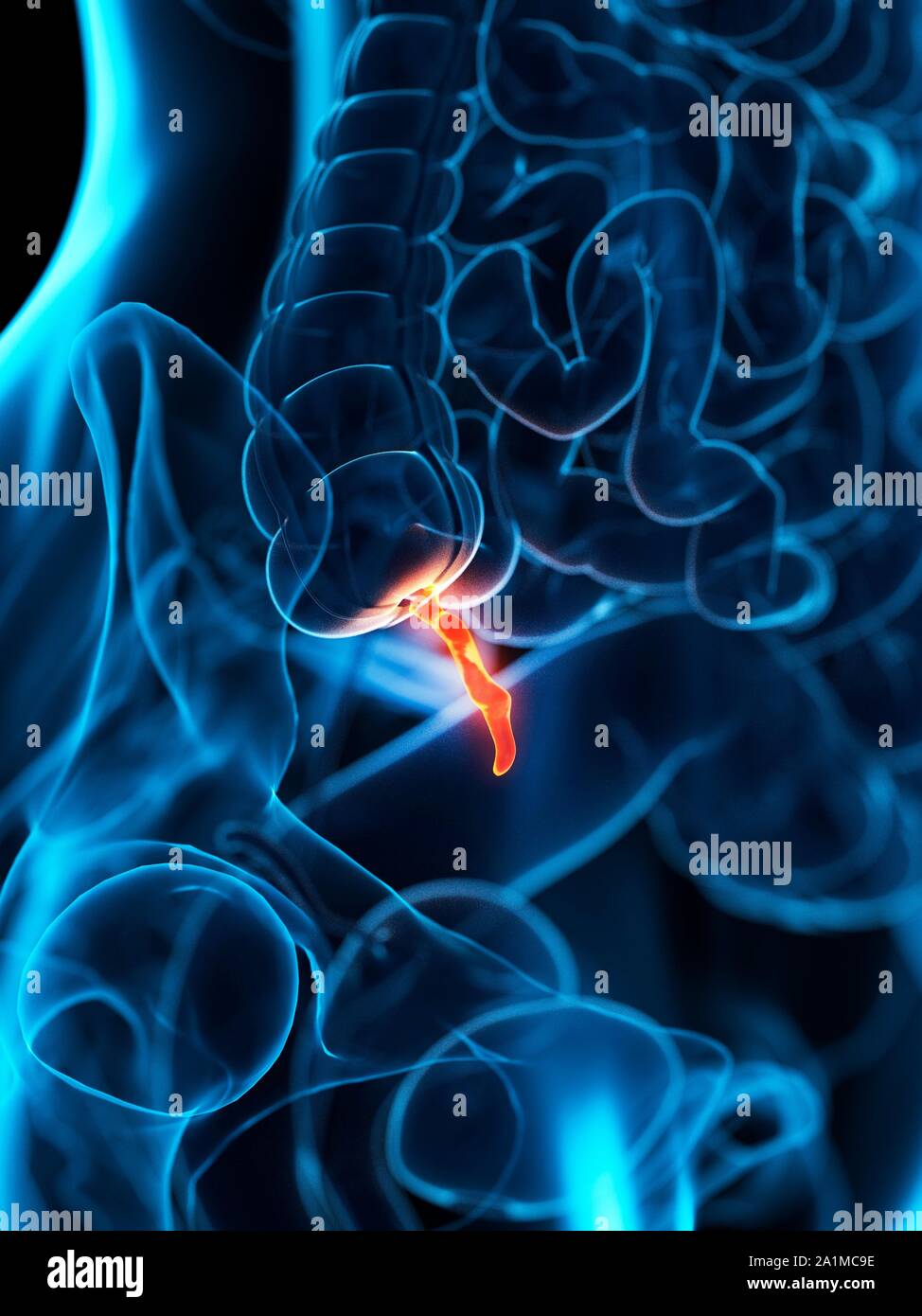 Inflamed appendix, conceptual computer illustration Stock Photo - Alamy