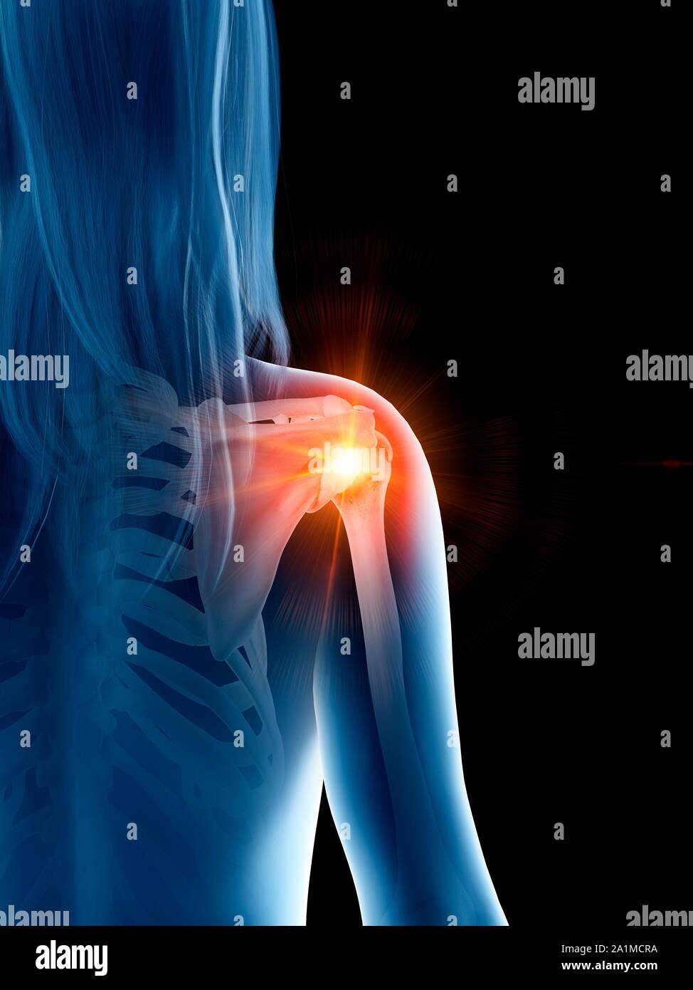 Shoulder pain conceptual computer artwork hi-res stock photography and ...