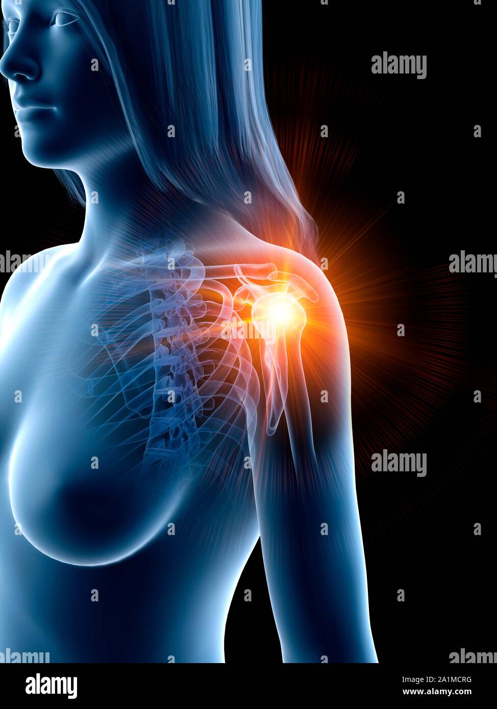 Shoulder pain, conceptual computer illustration Stock Photo - Alamy