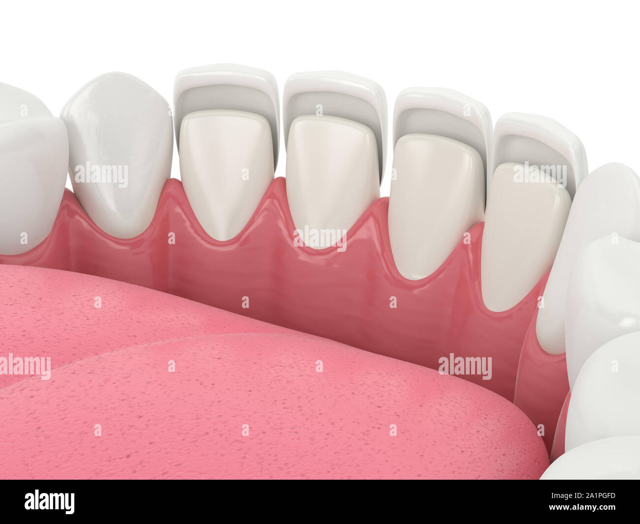 3d render of teeth with veneers over white Stock Photo - Alamy