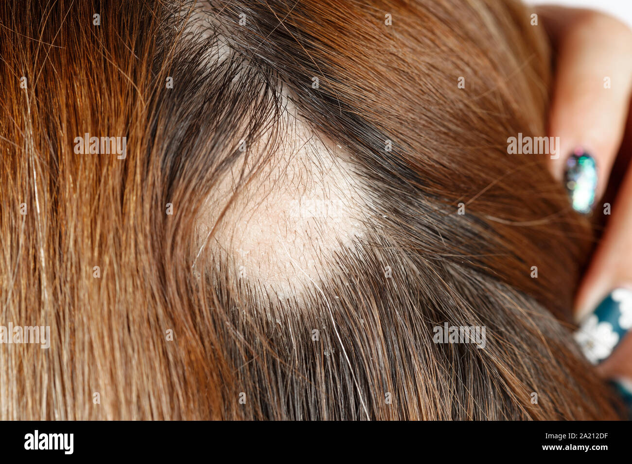 Female hair loss bald spot hi-res stock photography and images - Alamy