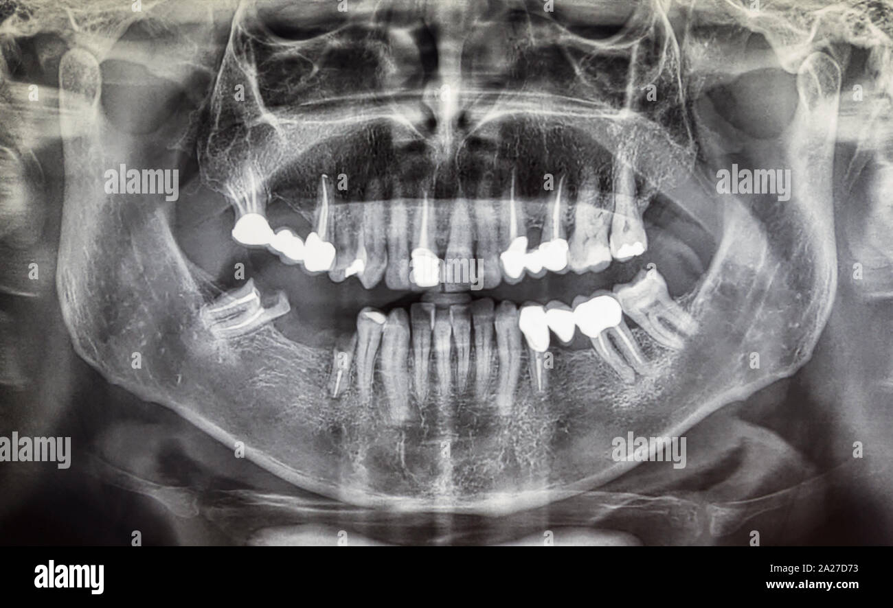 Orthopantomography of an adult patient, dentistry Stock Photo - Alamy