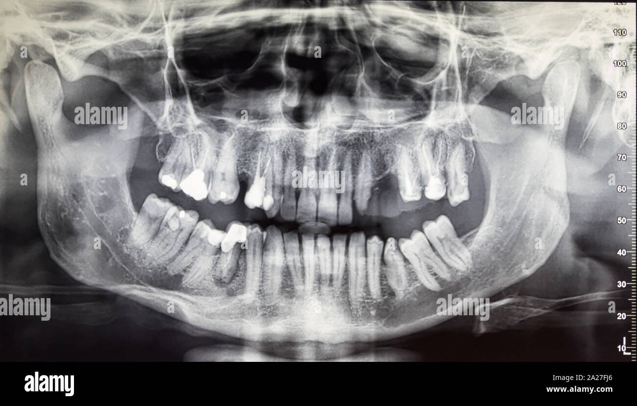 Orthopantomography of an adult patient, dentistry Stock Photo - Alamy