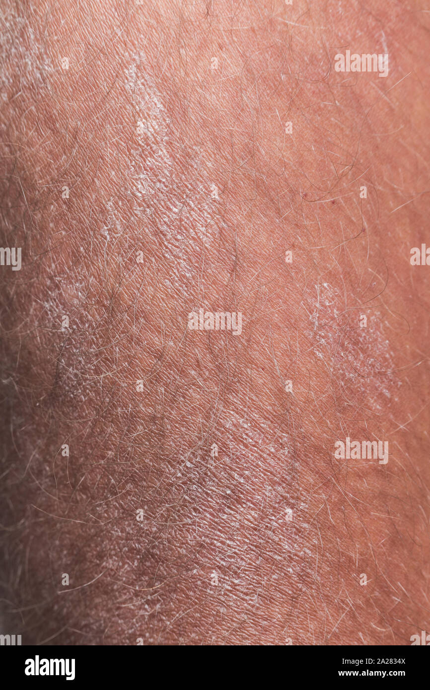 Large plaque parapsoriasis on caucasian man legs Stock Photo - Alamy