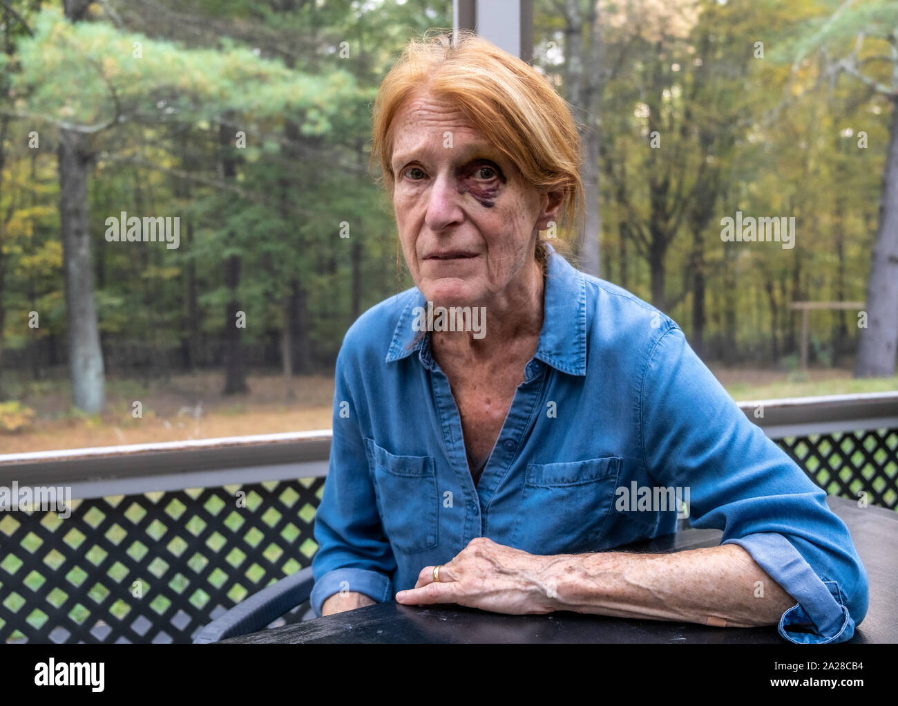 Swollen eye hi-res stock photography and images - Alamy