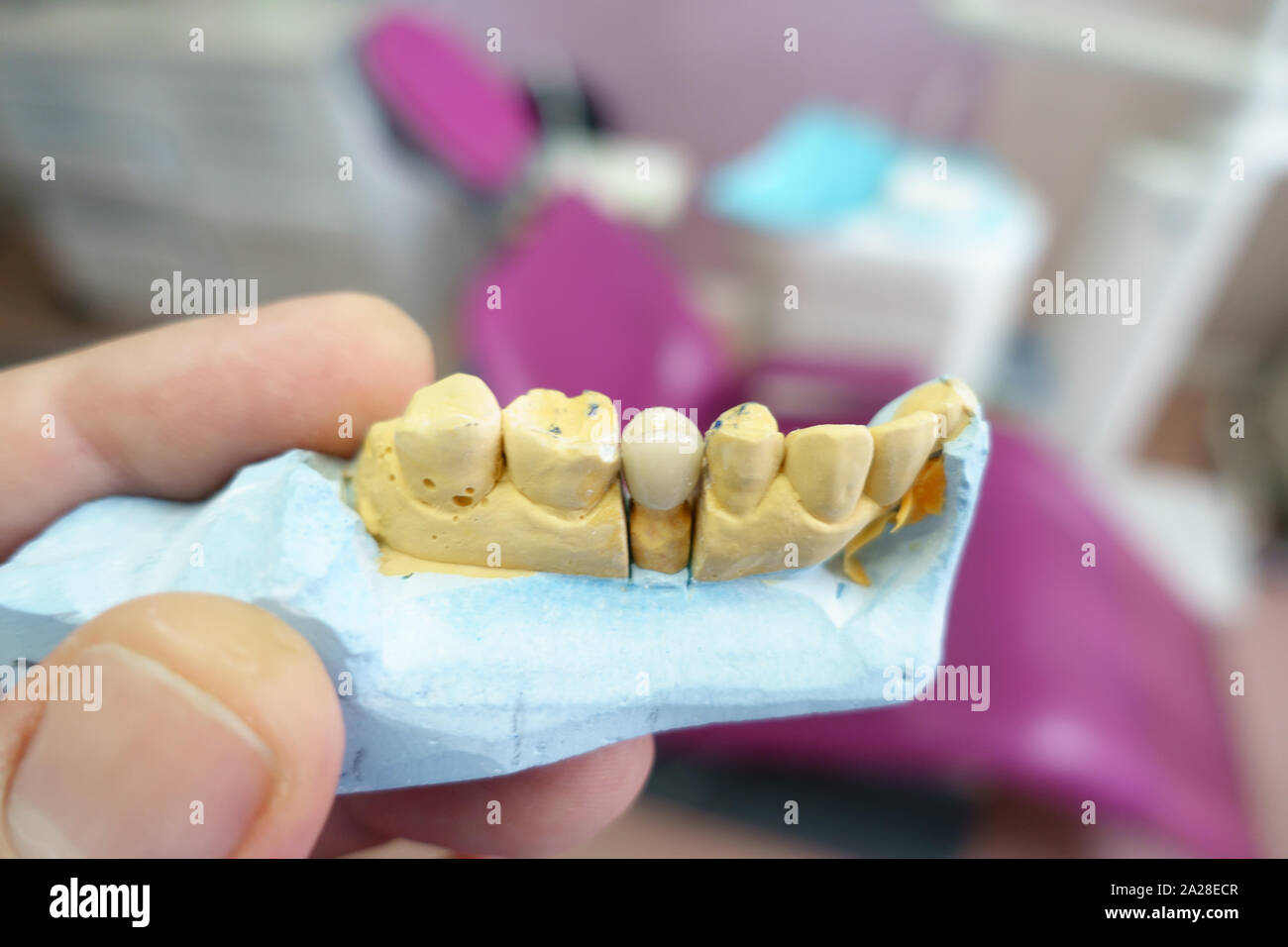 close-up ceramic tooth crown on a plaster model of teeth in the dentist ...