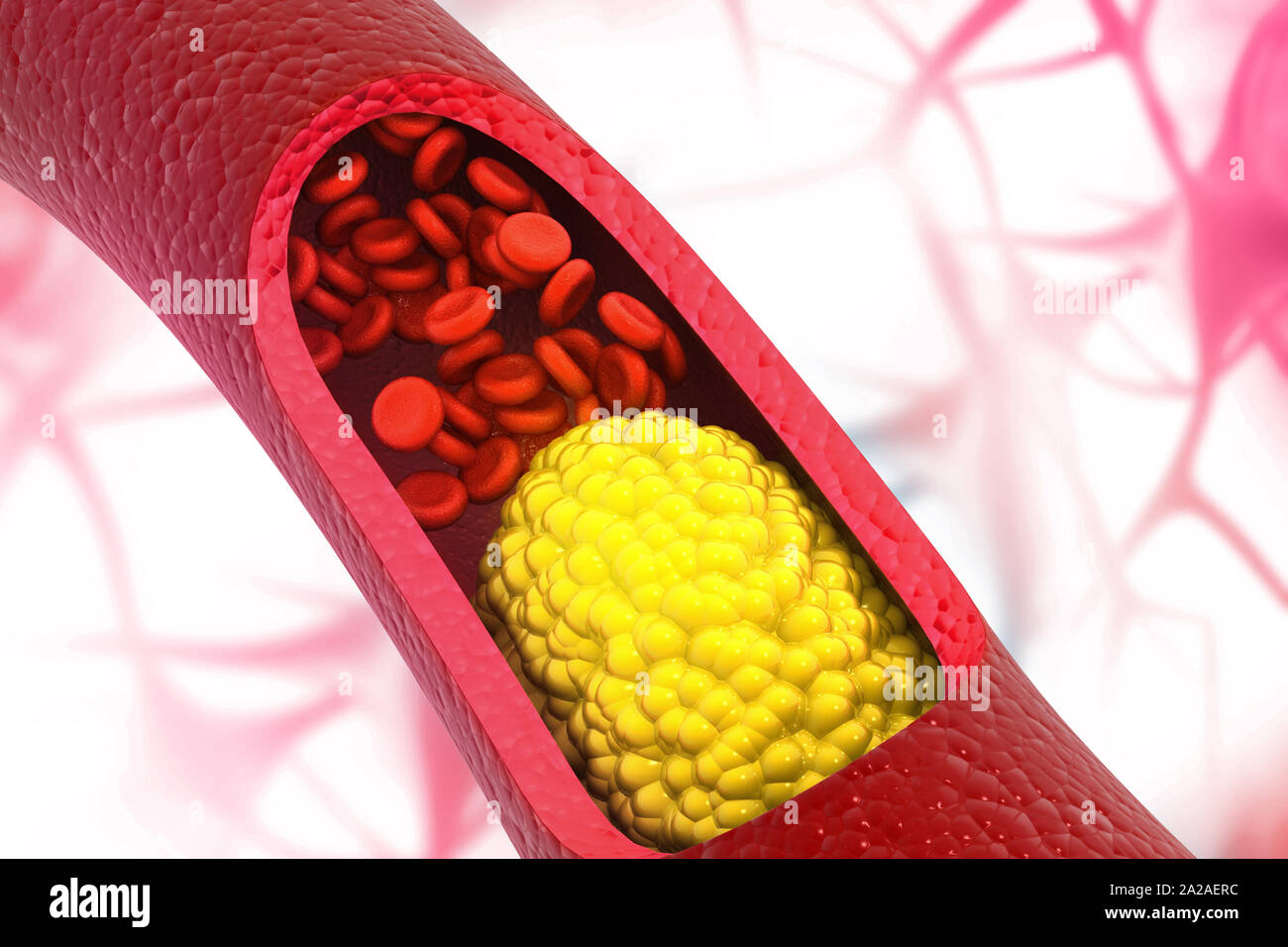 Clogged artery surgery hi-res stock photography and images - Alamy