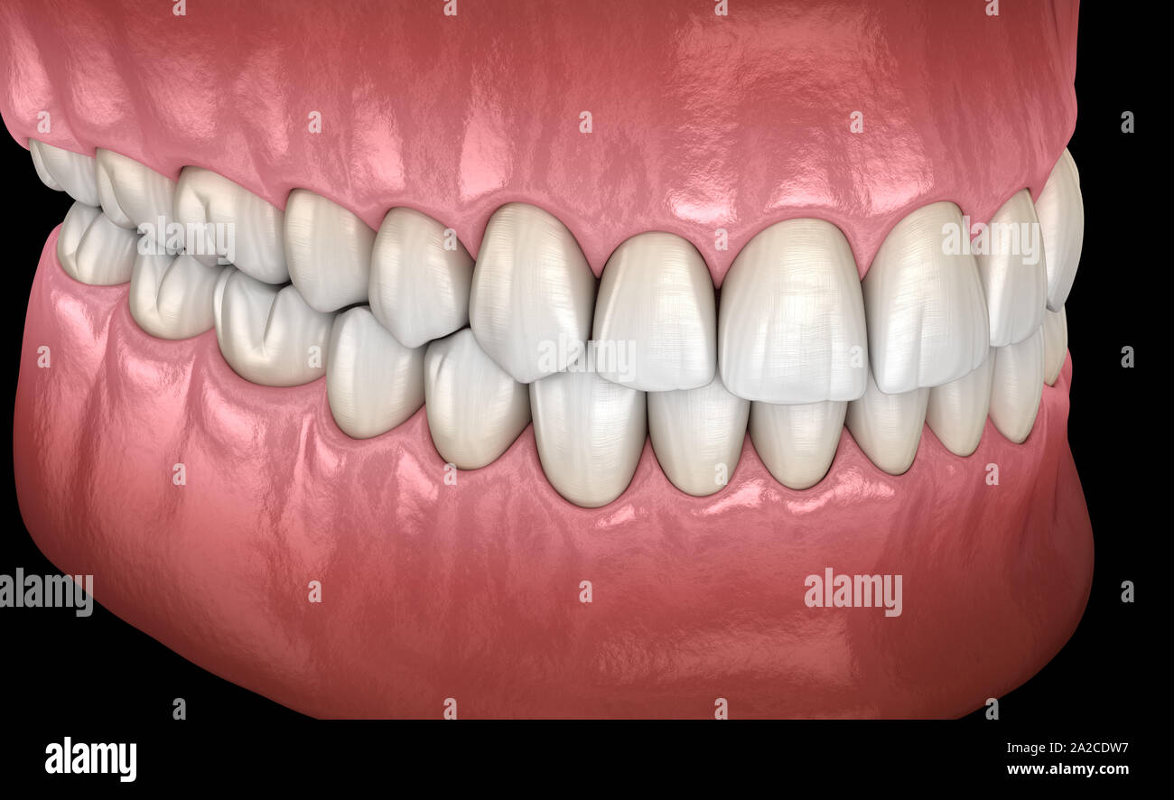 Healthy human teeth with normal occlusion, side view. Medically ...