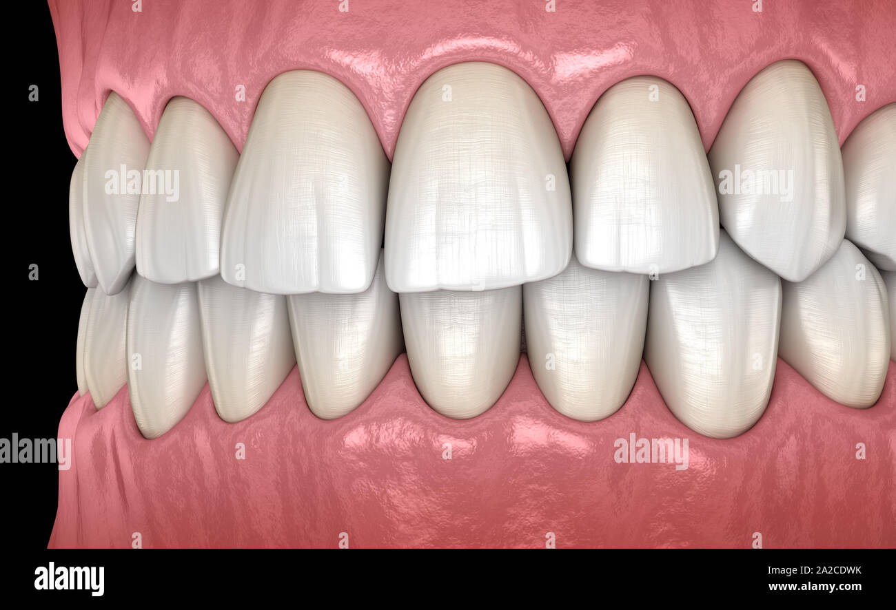 Healthy human teeth with normal occlusion, side view. Medically ...