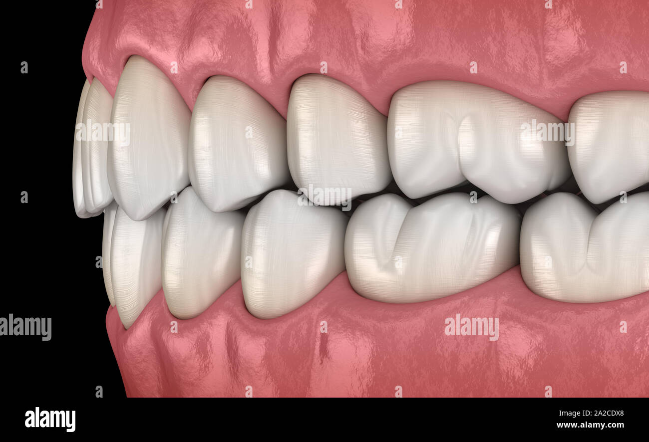 Healthy human teeth with normal occlusion, side view. Medically ...