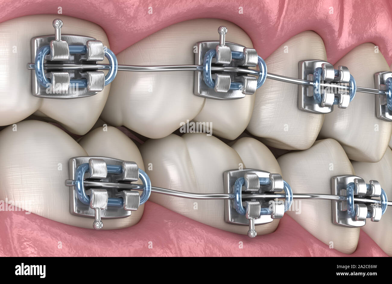 Teeth with metal braces in gums. Medically accurate dental 3D ...