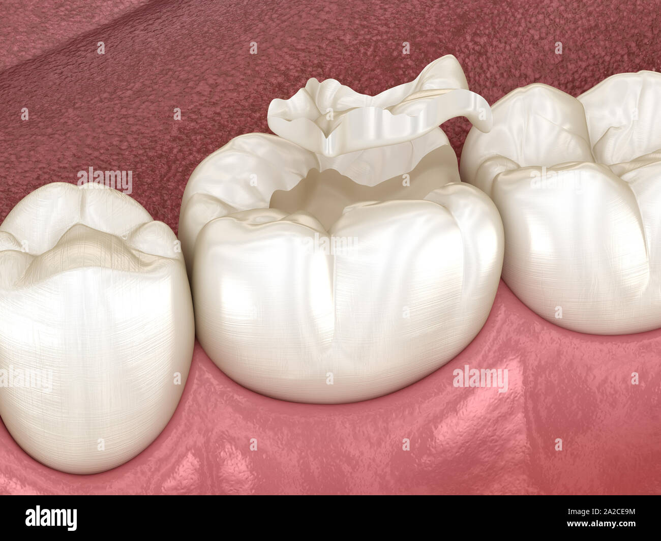 Inlay ceramic crown fixation over tooth. Medically accurate 3D ...