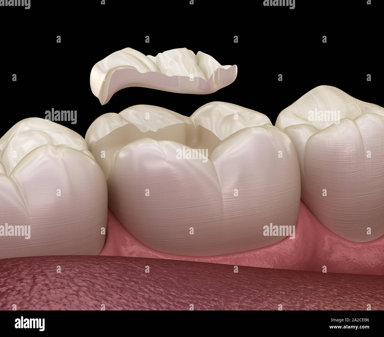 Inlay ceramic crown fixation over tooth. Medically accurate 3D ...