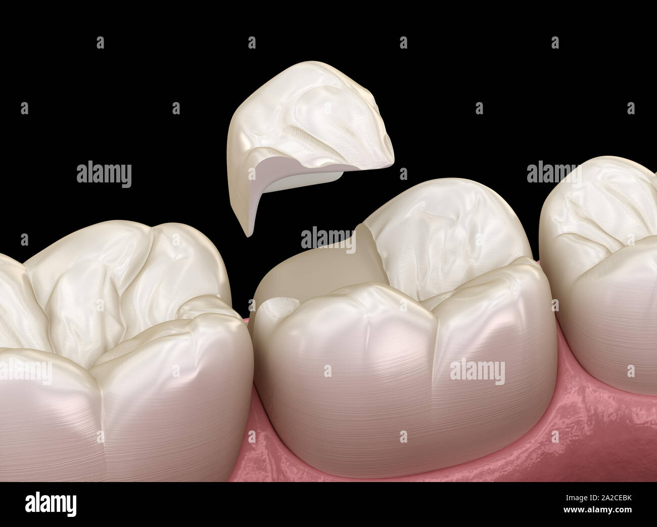 Onlay ceramic crown fixation over tooth. Medically accurate 3D ...