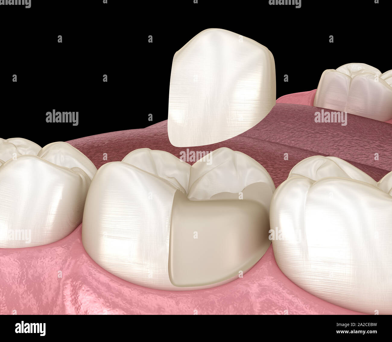 Onlay ceramic crown fixation over tooth. Medically accurate 3D ...