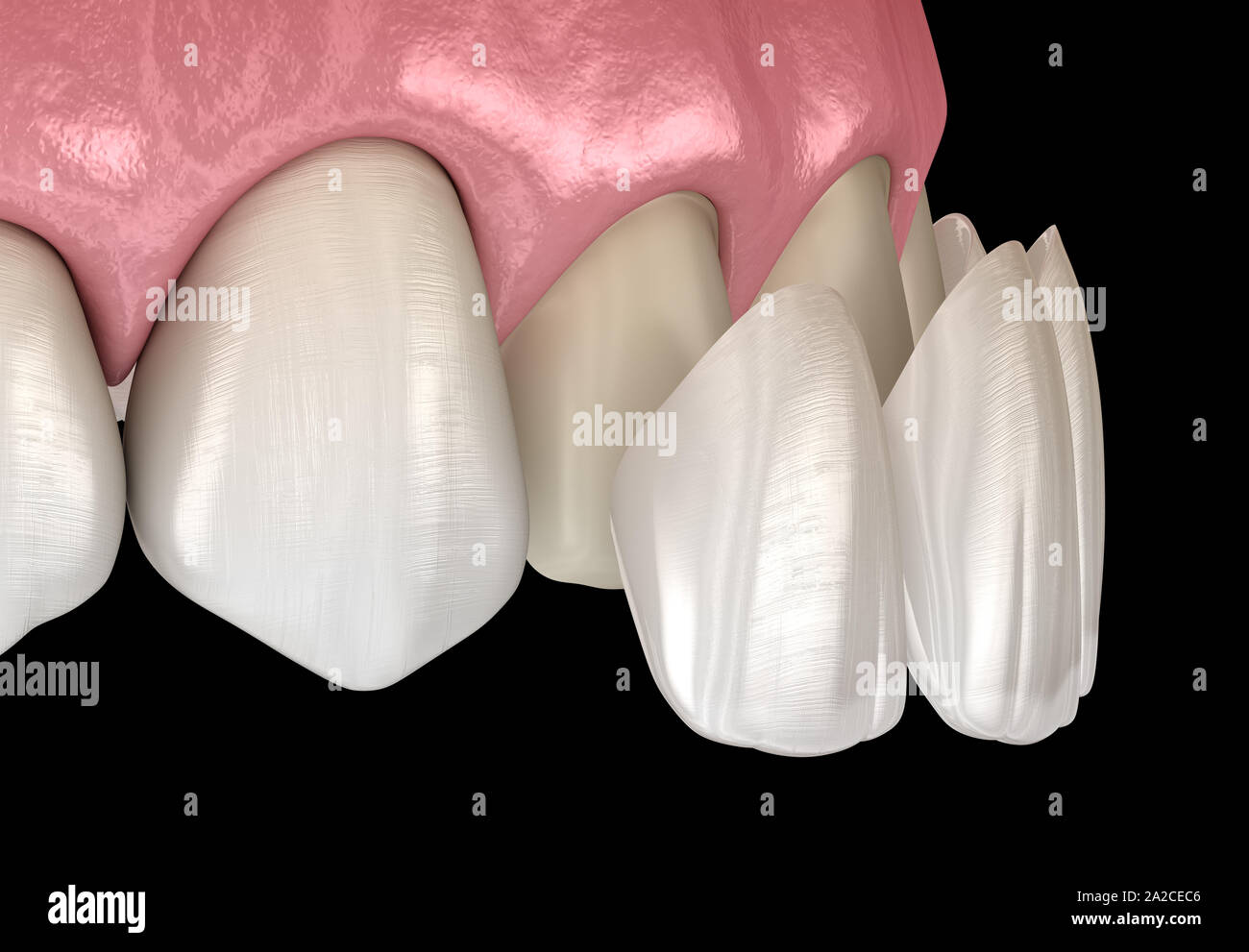 Veneer installation procedure over central incisor and lateral incisor ...