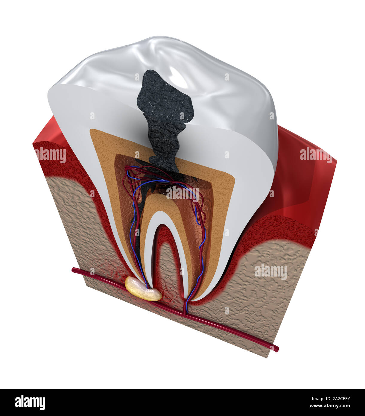 Tooth decay. Medically accurate tooth 3D illustration Stock Photo - Alamy