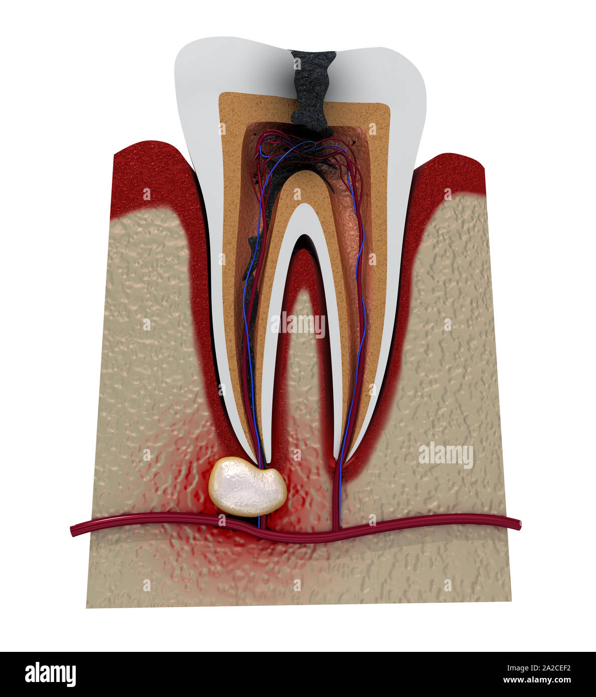 Tooth decay. Medically accurate tooth 3D illustration Stock Photo - Alamy