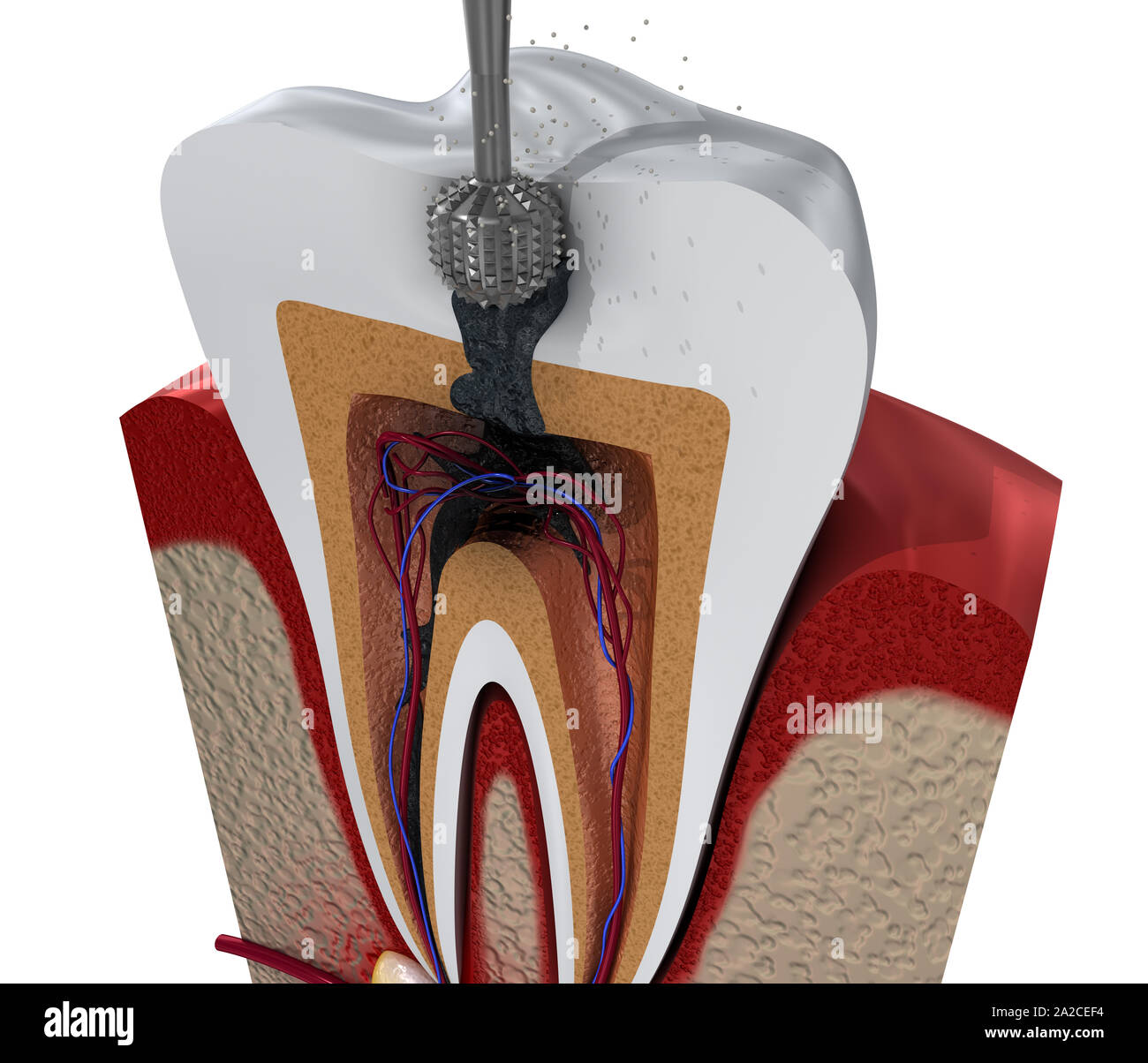 Tooth decay. Medically accurate tooth 3D illustration Stock Photo - Alamy