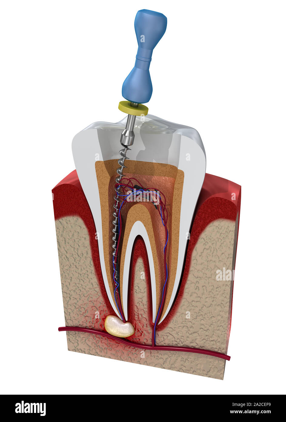 Root canal treatment process. 3D illustration Stock Photo - Alamy