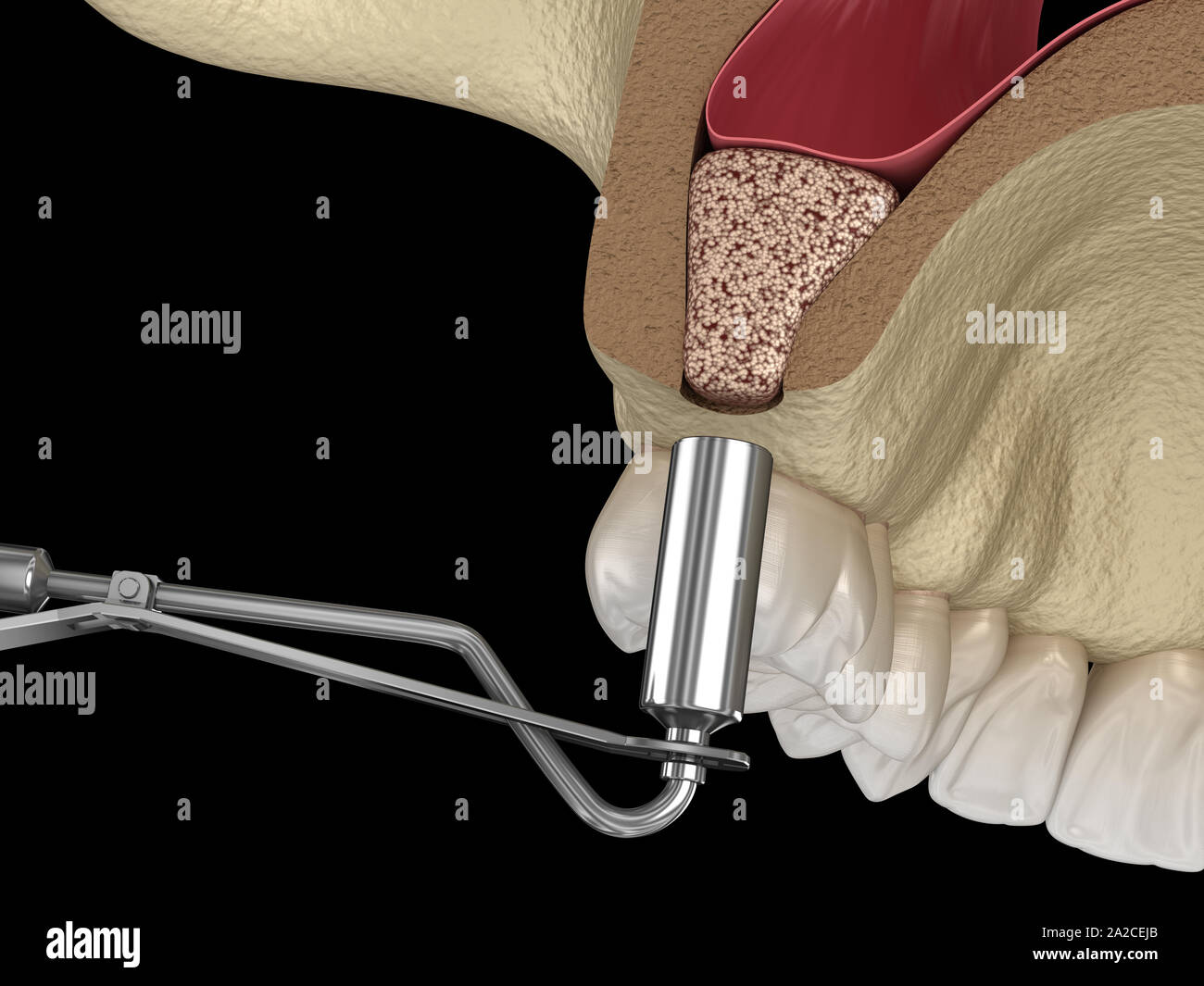 Sinus Lift Surgery - Adding new bone. 3D illustration Stock Photo - Alamy