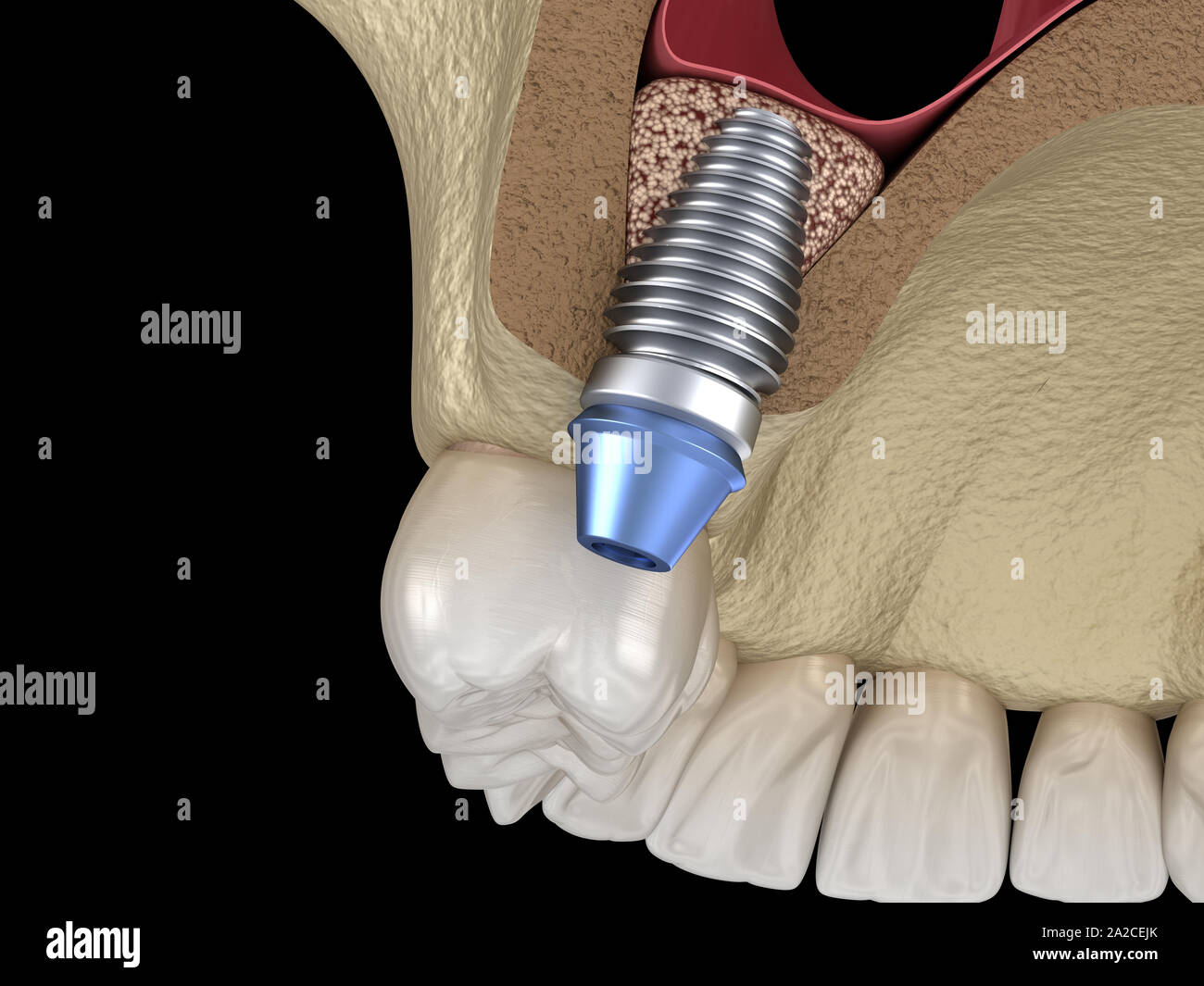 Sinus Lift Surgery - implant installation. 3D illustration Stock Photo ...