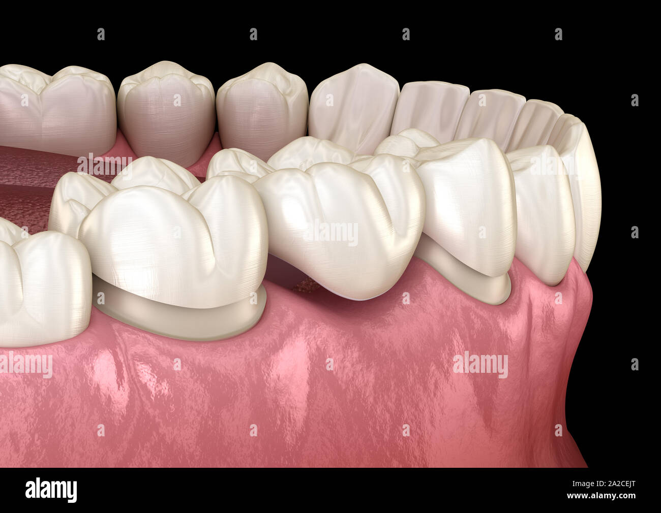 Dental bridge of 3 teeth over molar and premolar. Medically accurate 3D ...
