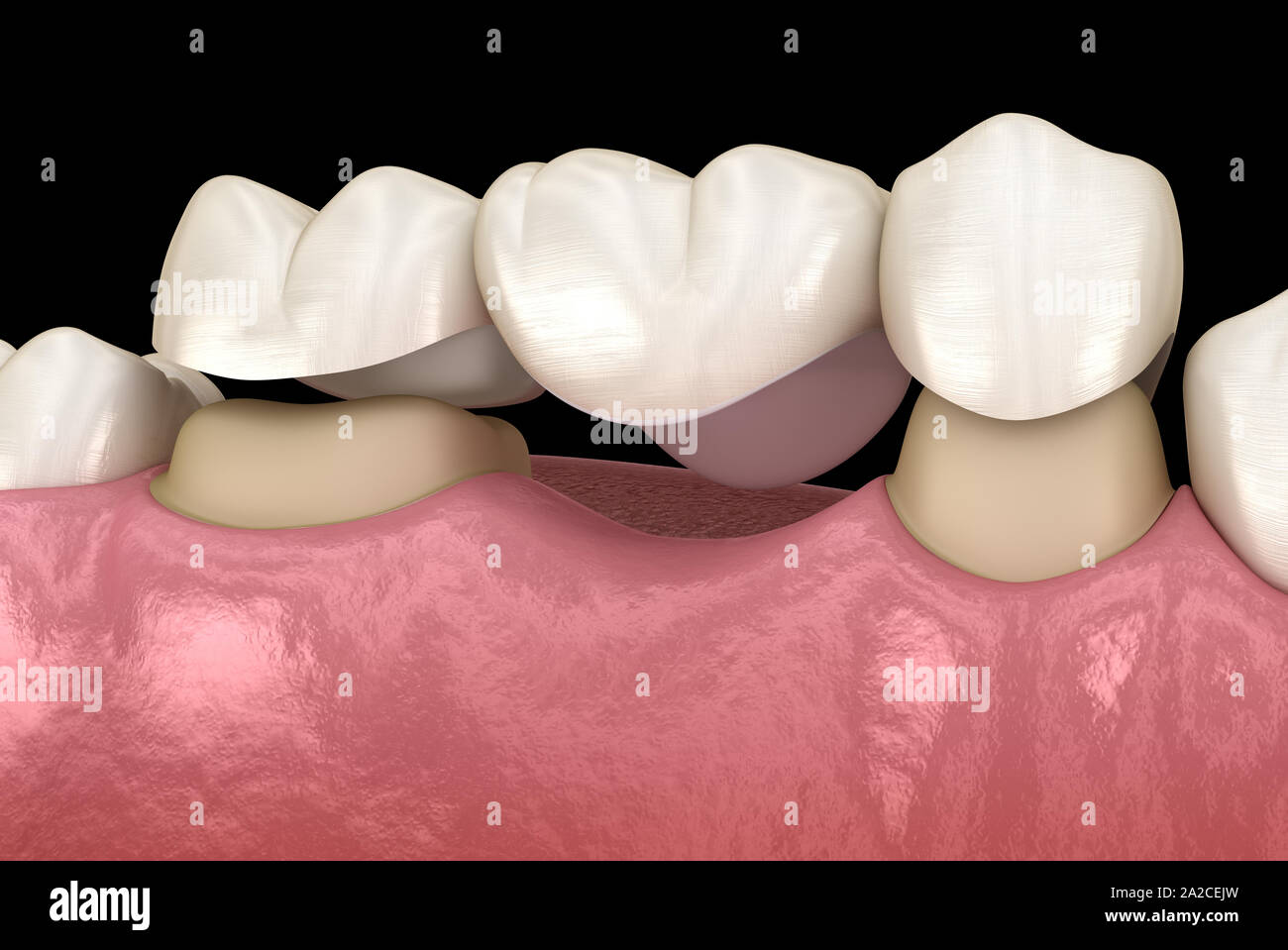 Dental bridge of 3 teeth over molar and premolar. Medically accurate 3D ...