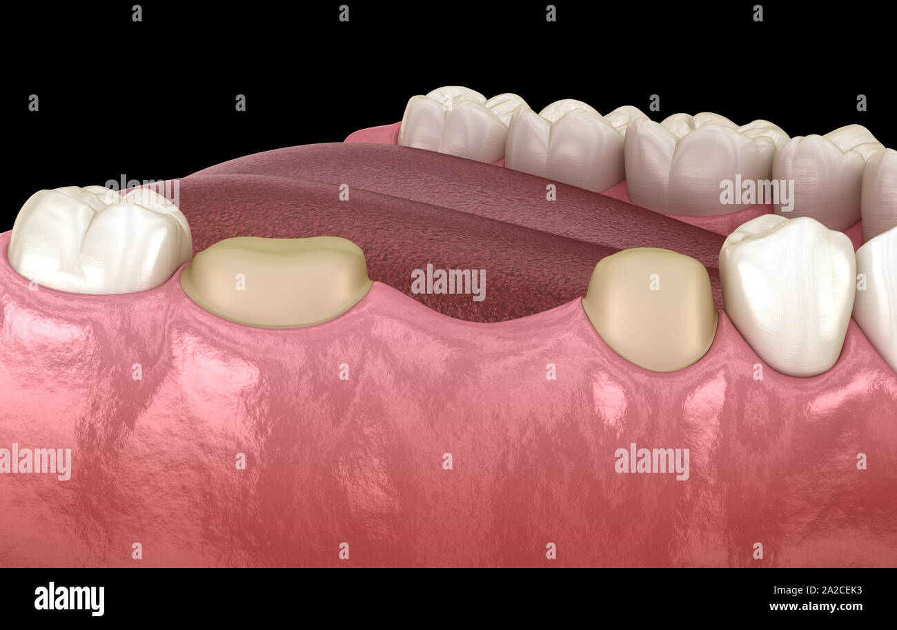 Preparated molar and premolar tooth for dental bridge placement ...