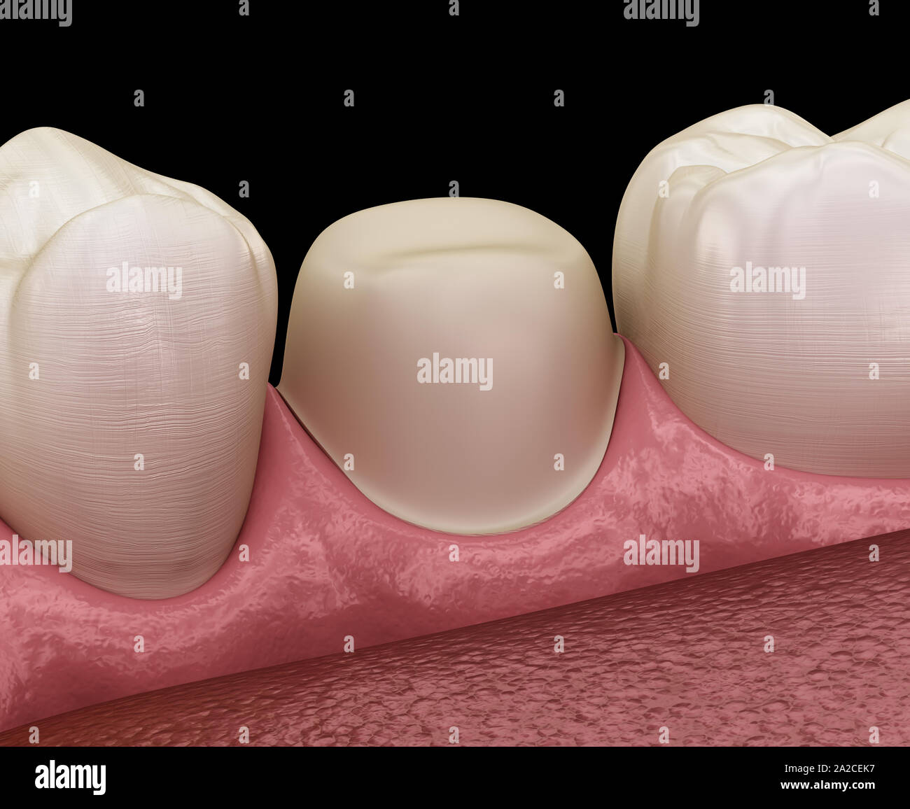 Preparated premolar tooth for dental crown placement. Medically ...