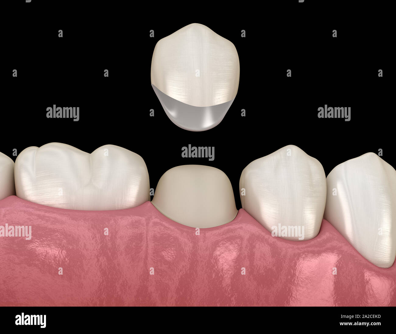 Preparated premolar tooth for dental crown placement. Medically ...