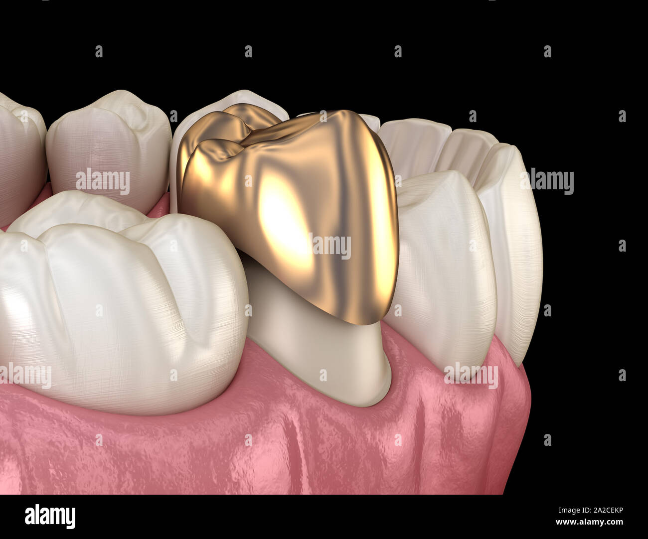 Golden crown premolar tooth assembly process. Medically accurate 3D ...